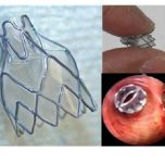 PulmonX Endobronchial Valve EBV Therapy – Compass Medical