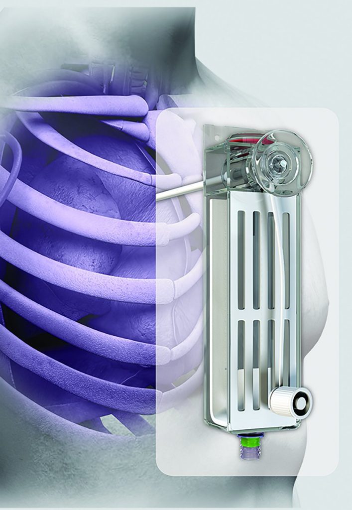 Uresil THORA-VENT for Pneumothorax – Compass Medical