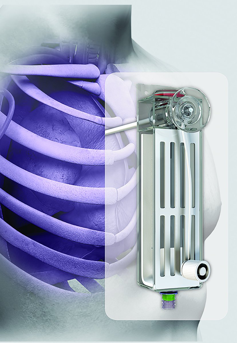 Uresil THORA-VENT for Pneumothorax – Compass Medical